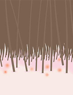 Follikulitt (betennelse i hårsekk) - Guide til riktig pleie